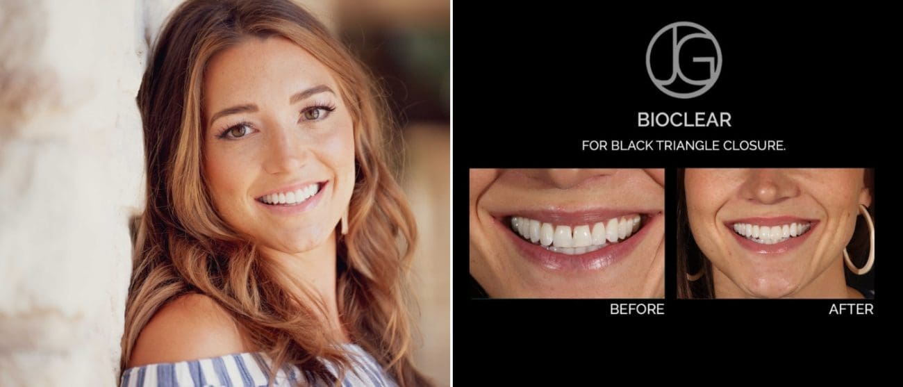 Bioclear in Plano, TX | Jacob Grapevine, DDS - Signature Dentistry